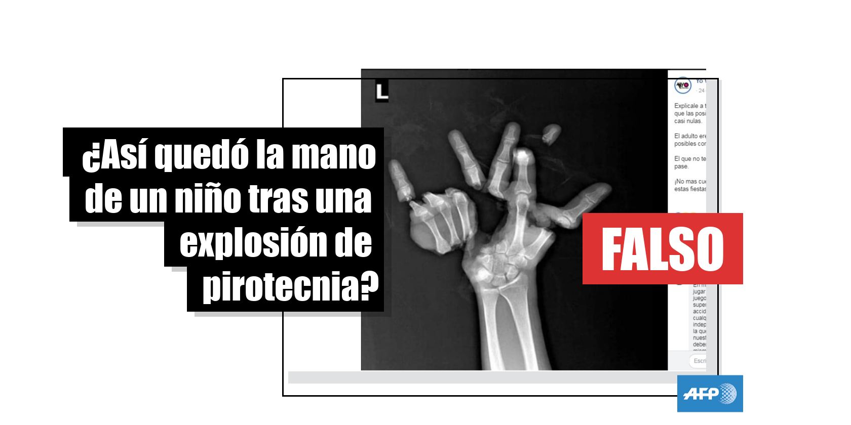 Radiografías De Manos Rotas Archivo:X Ray Of Normal Hand By