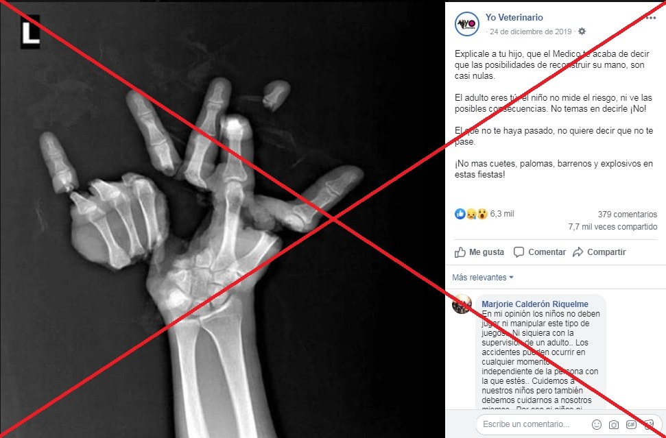 La radiografía no muestra la mano de un niño lastimada por fuegos ...